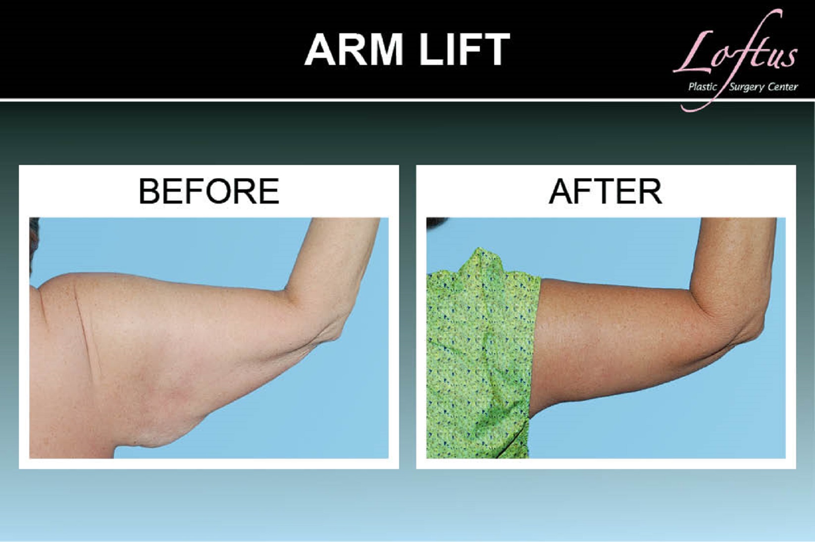 Photos Arm Lift Before After Images