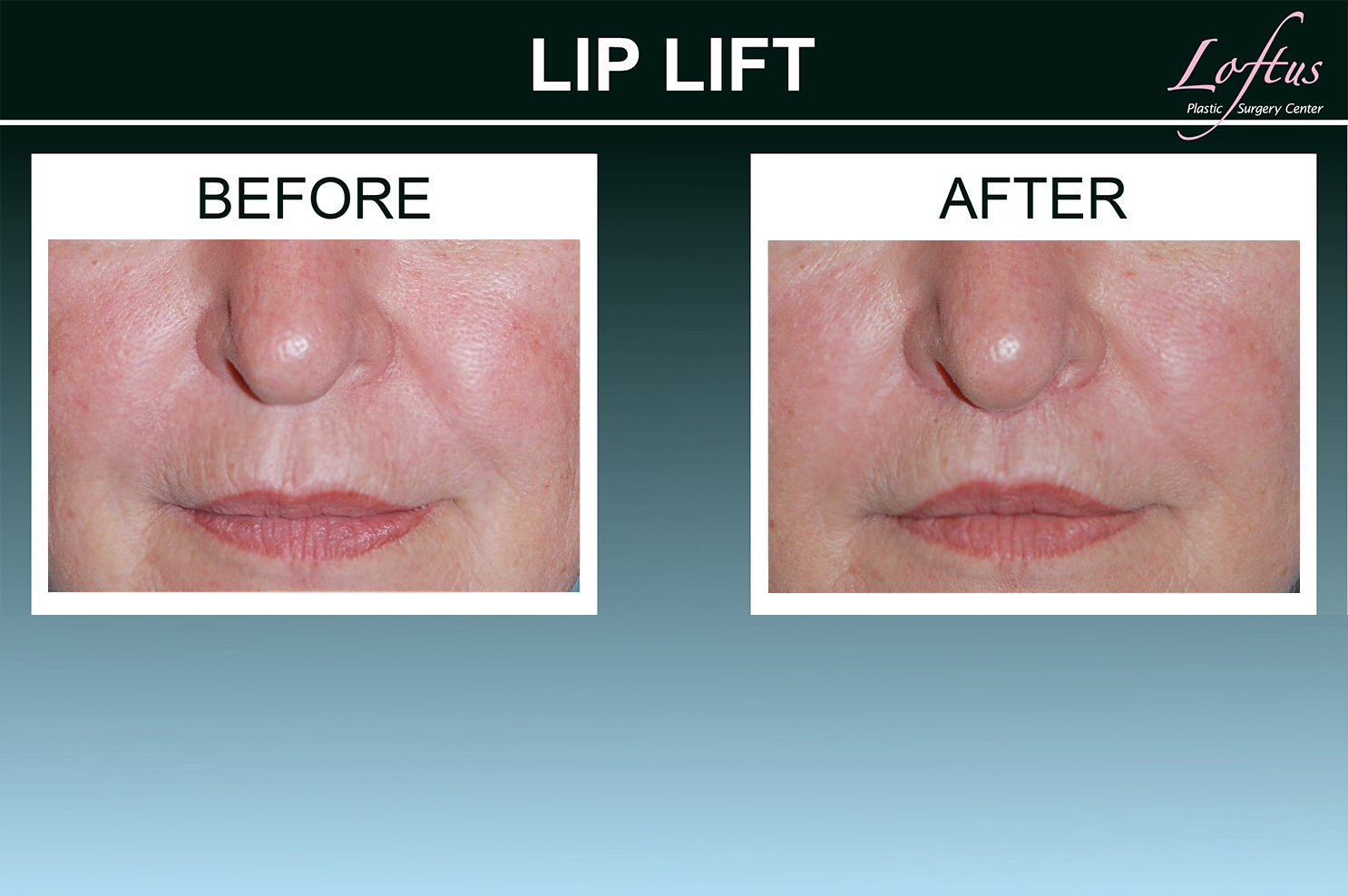 Loftus Plastic Surgery - Lips