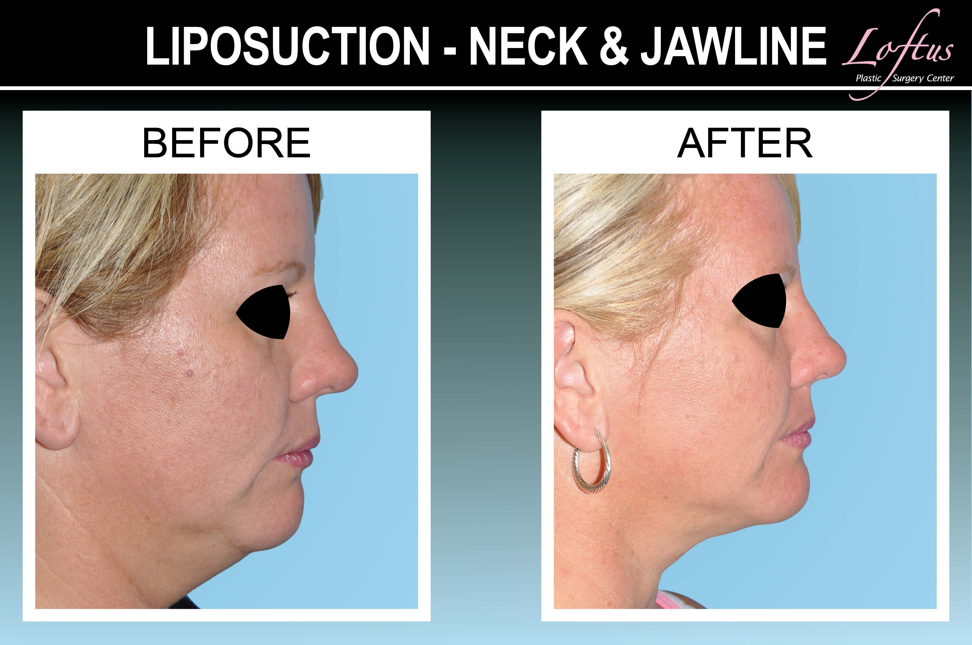 Photos - Neck Lipo