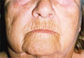 Photos - Phenol Peel